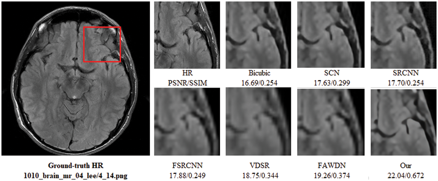 CMES | Free Full-Text | IRMIRS: Inception-ResNet-Based Network for MRI ...