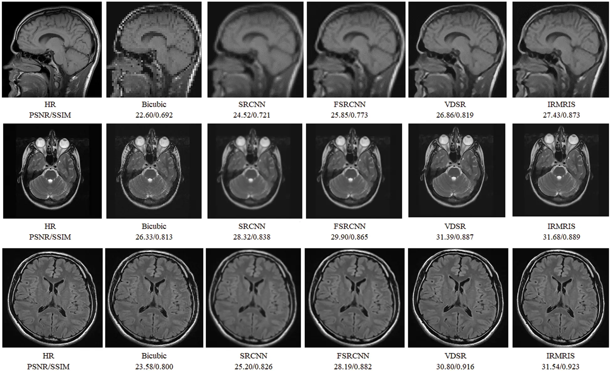 CMES | Free Full-Text | IRMIRS: Inception-ResNet-Based Network for MRI ...