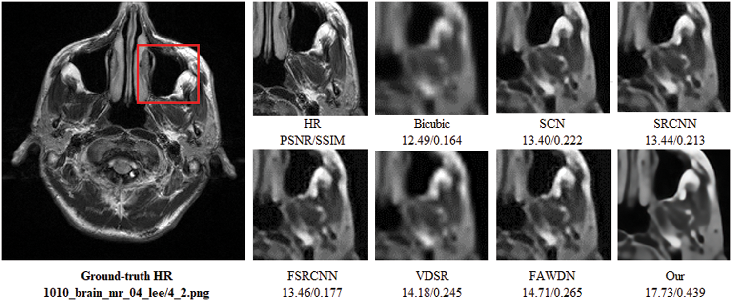 CMES | Free Full-Text | IRMIRS: Inception-ResNet-Based Network for MRI ...