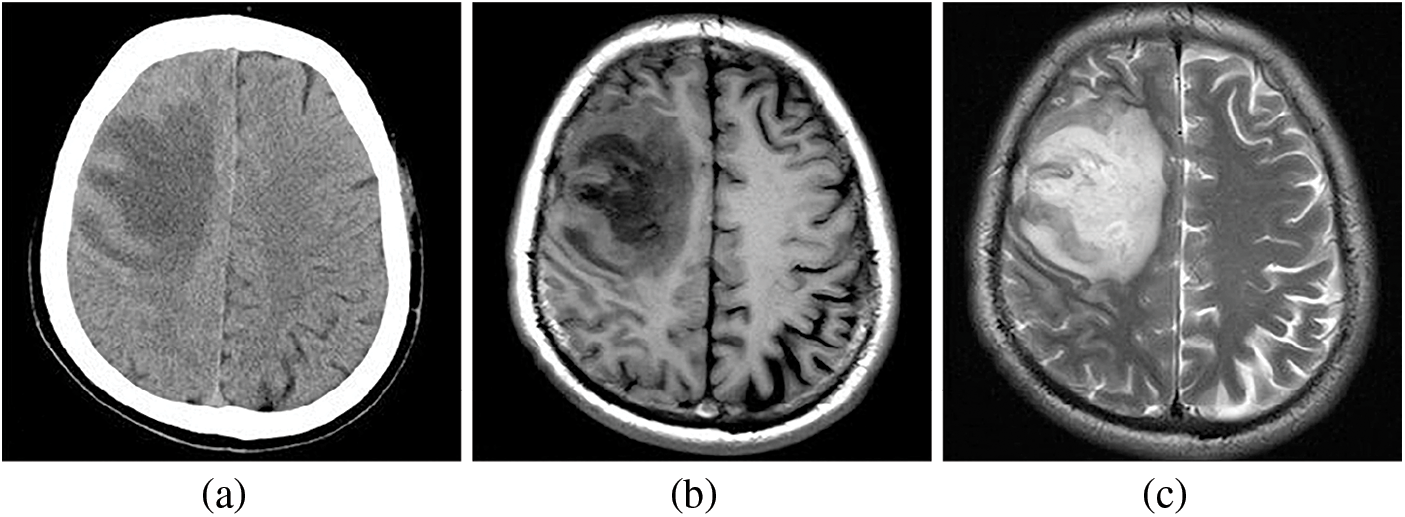 CMES | Free Full-Text | Contrast Normalization Strategies in Brain ...