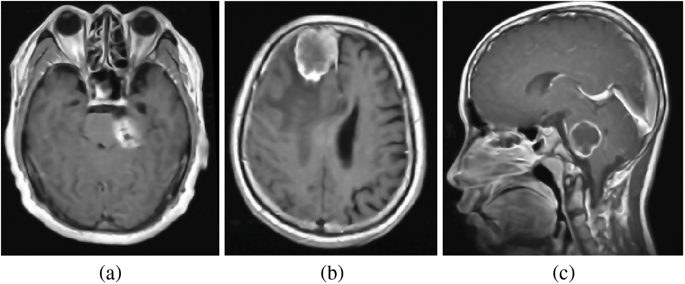 CMES | Free Full-Text | Contrast Normalization Strategies in Brain ...