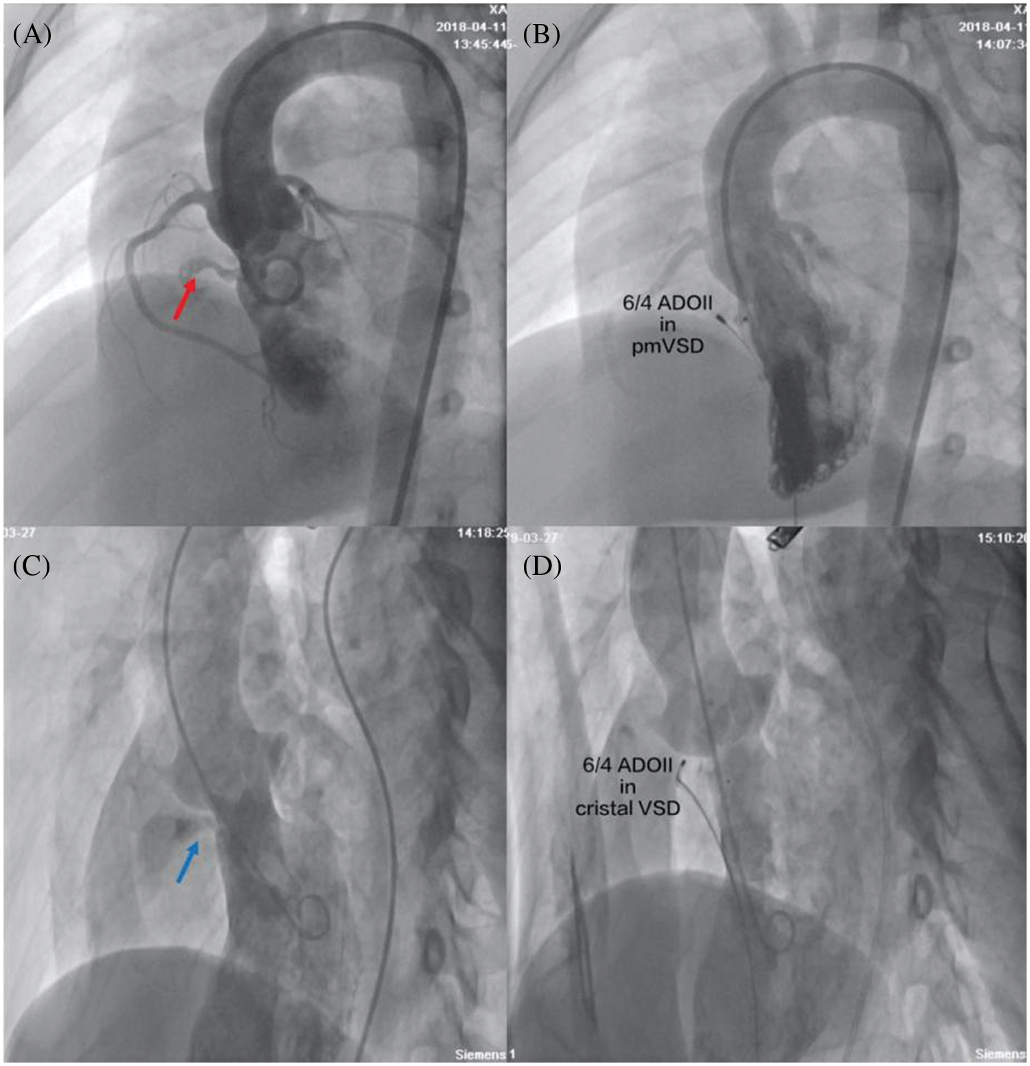CHD | Free Full-Text | Effectiveness and Safety of Transcatheter ...