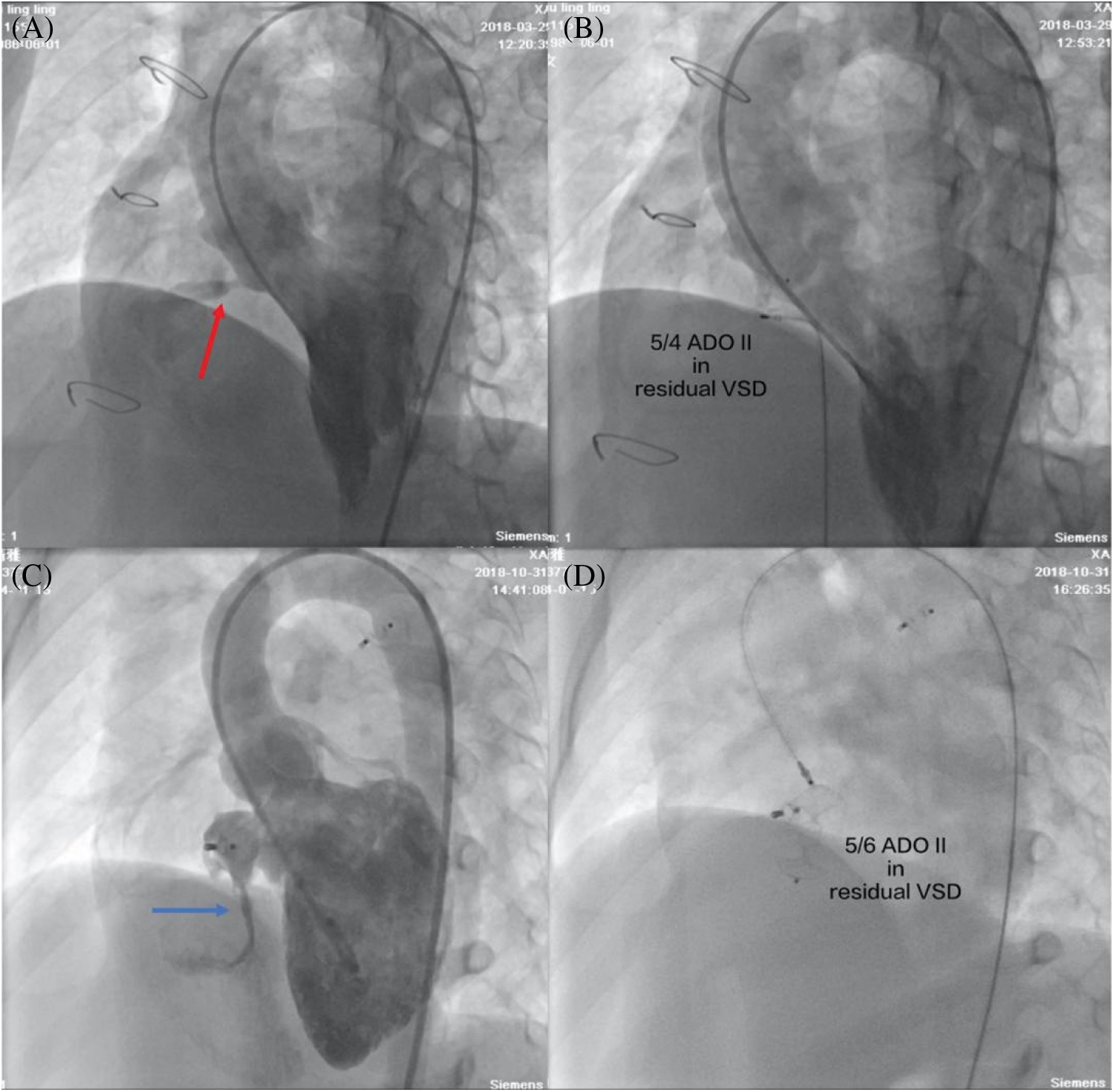 CHD | Free Full-Text | Effectiveness and Safety of Transcatheter ...