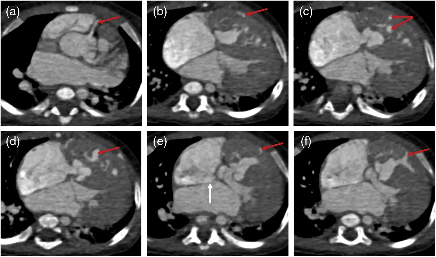 CHD | Free Full-Text | Assessment of Intracardiac and Extracardiac ...