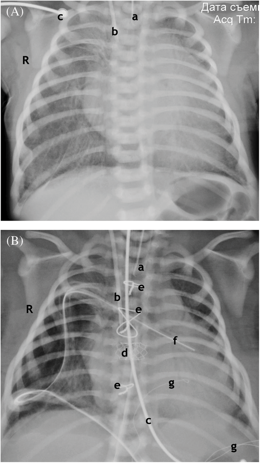 CHD | Free Full-Text | Emergency Hybrid Correction in a Newborn with ...