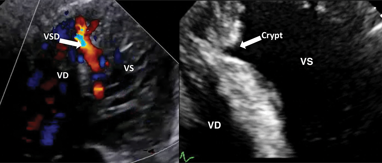 CHD | Free Full-Text | Ventricular Septal Crypts: Remnants of ...