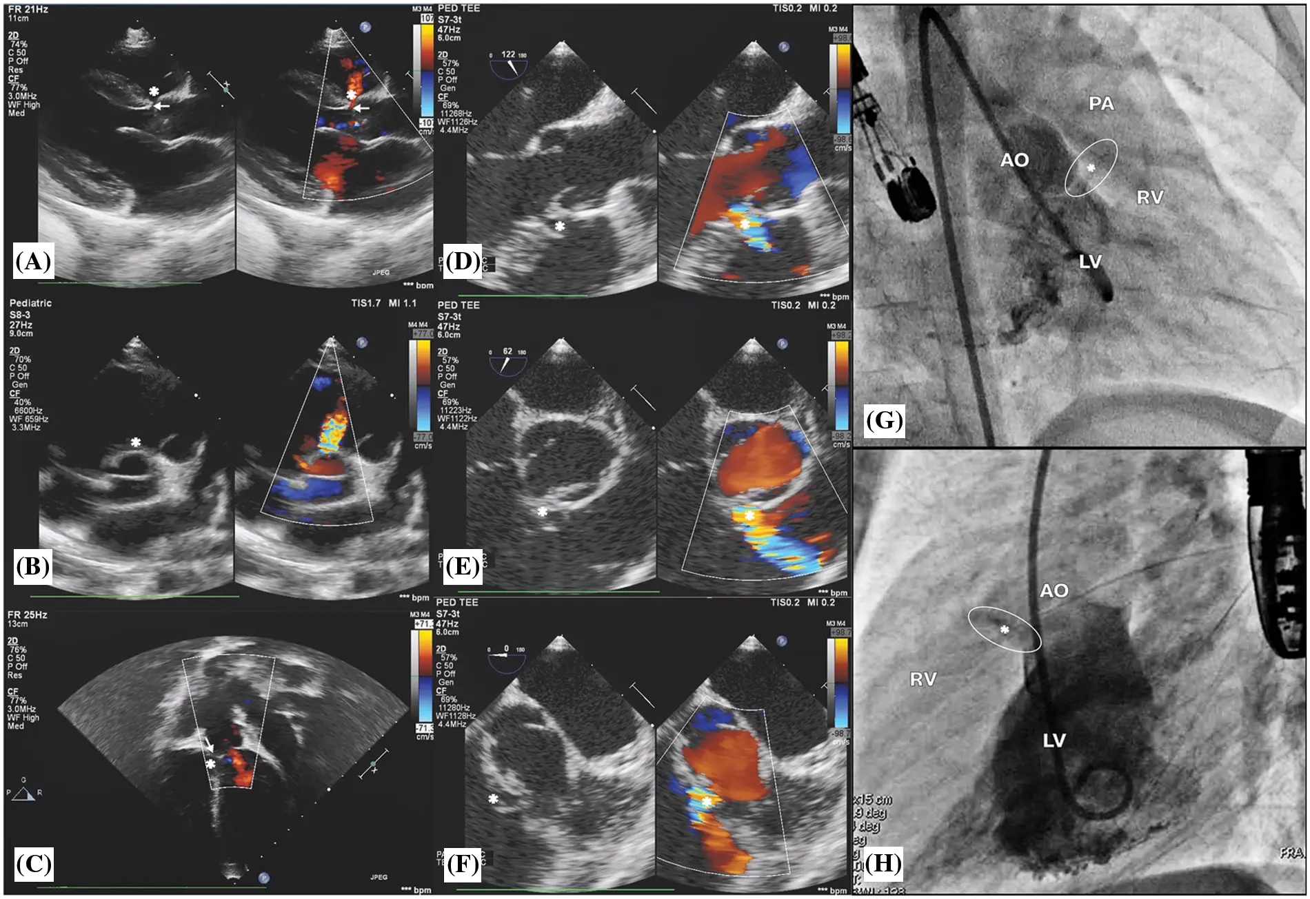 CHD | Free Full-Text | Outcomes of Transcatheter Closure in Outlet-Type ...