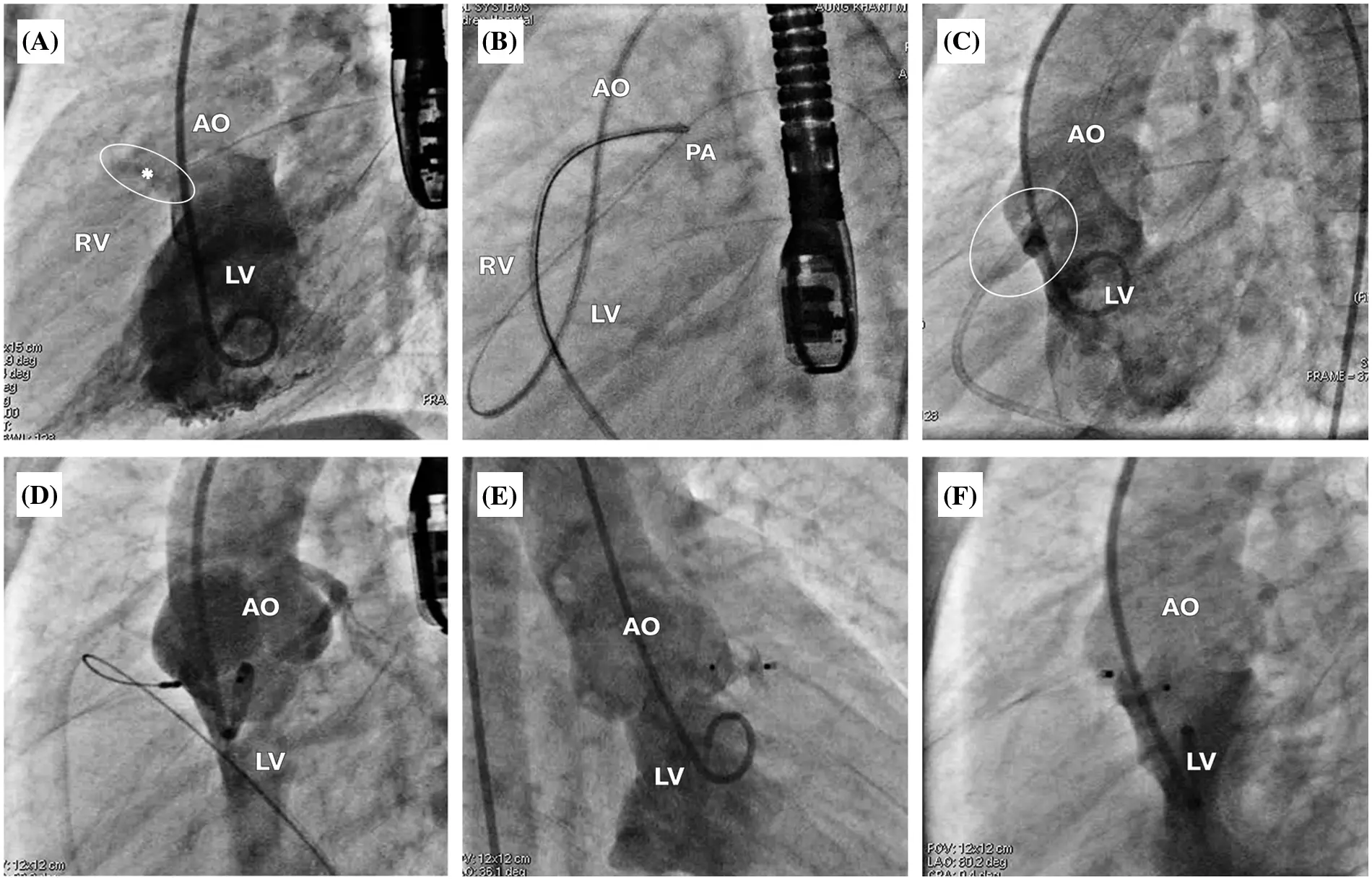 CHD | Free Full-Text | Outcomes of Transcatheter Closure in Outlet-Type ...