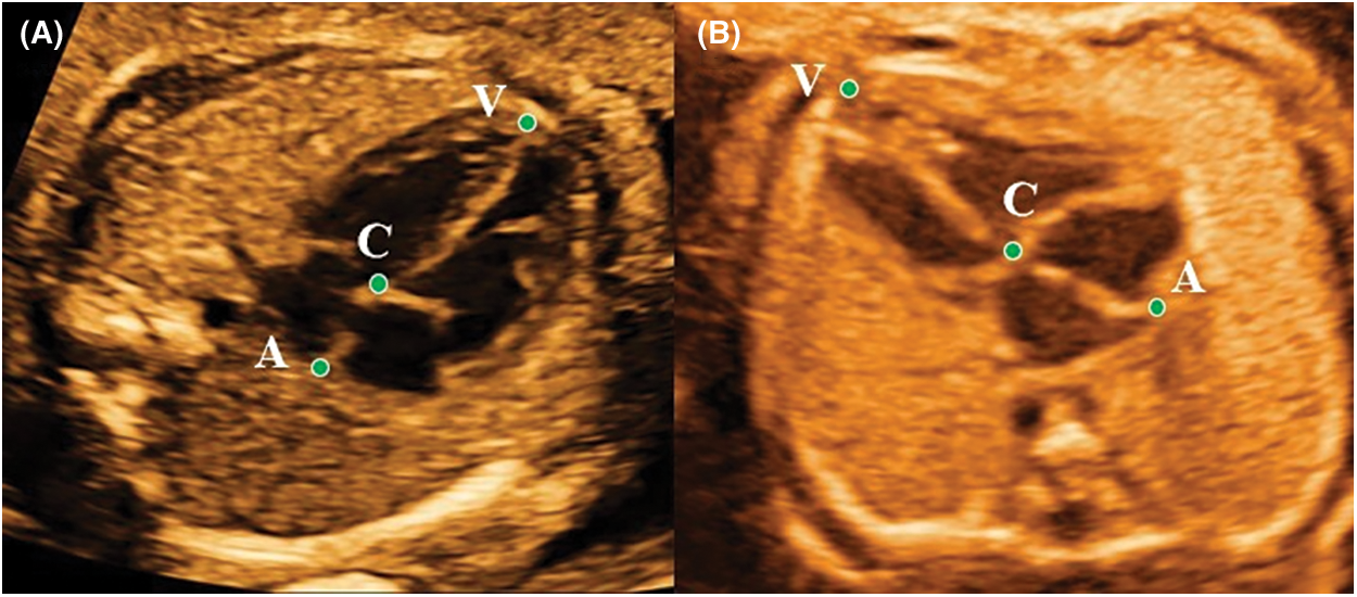 CHD | Free Full-Text | Quantitative Parameters Analysis for Prenatally ...