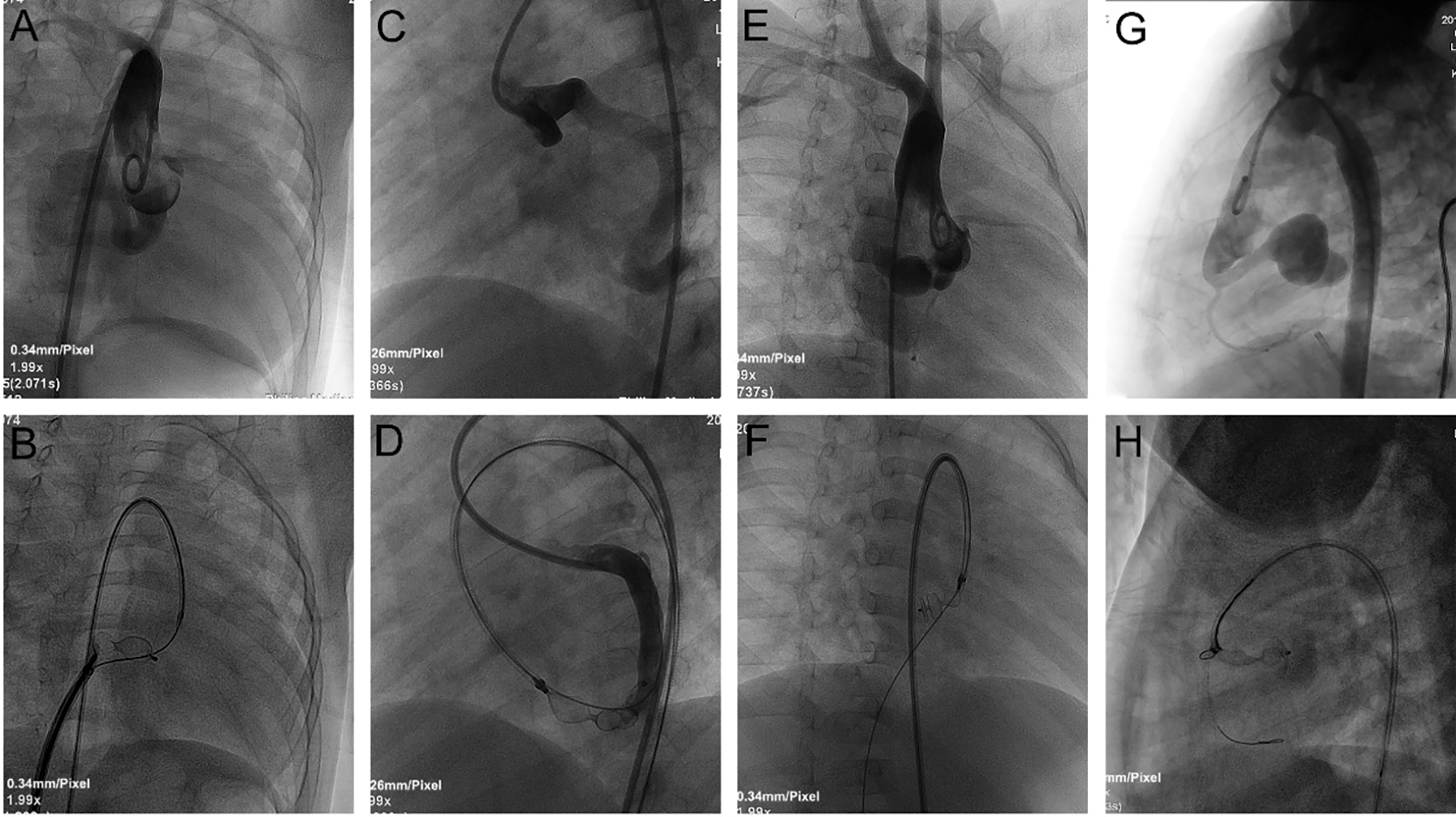 CHD | Free Full-Text | Intermediate and Long-Term Follow-Up of ...