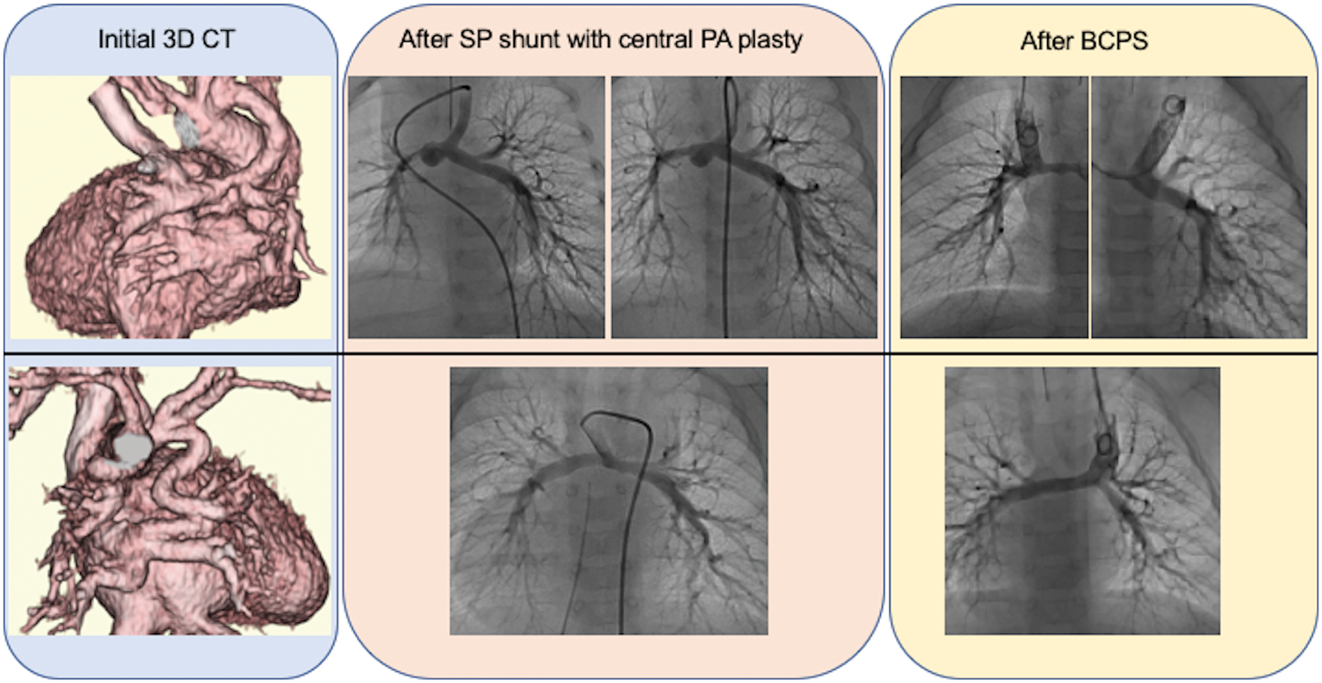 CHD | Free Full-Text | Long-Term Outcomes of Systemic-to-Pulmonary ...