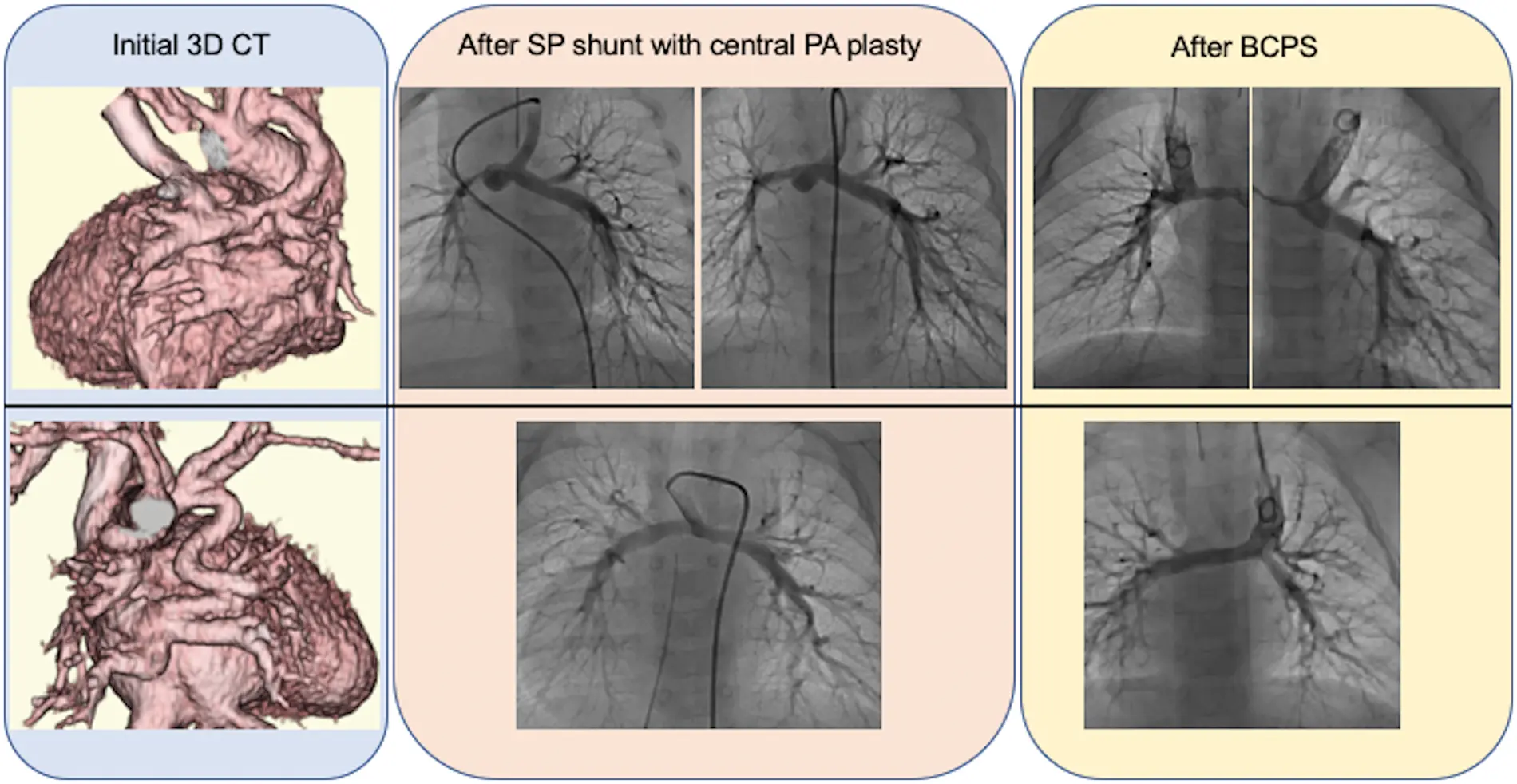 CHD | Free Full-Text | Long-Term Outcomes of Systemic-to-Pulmonary ...