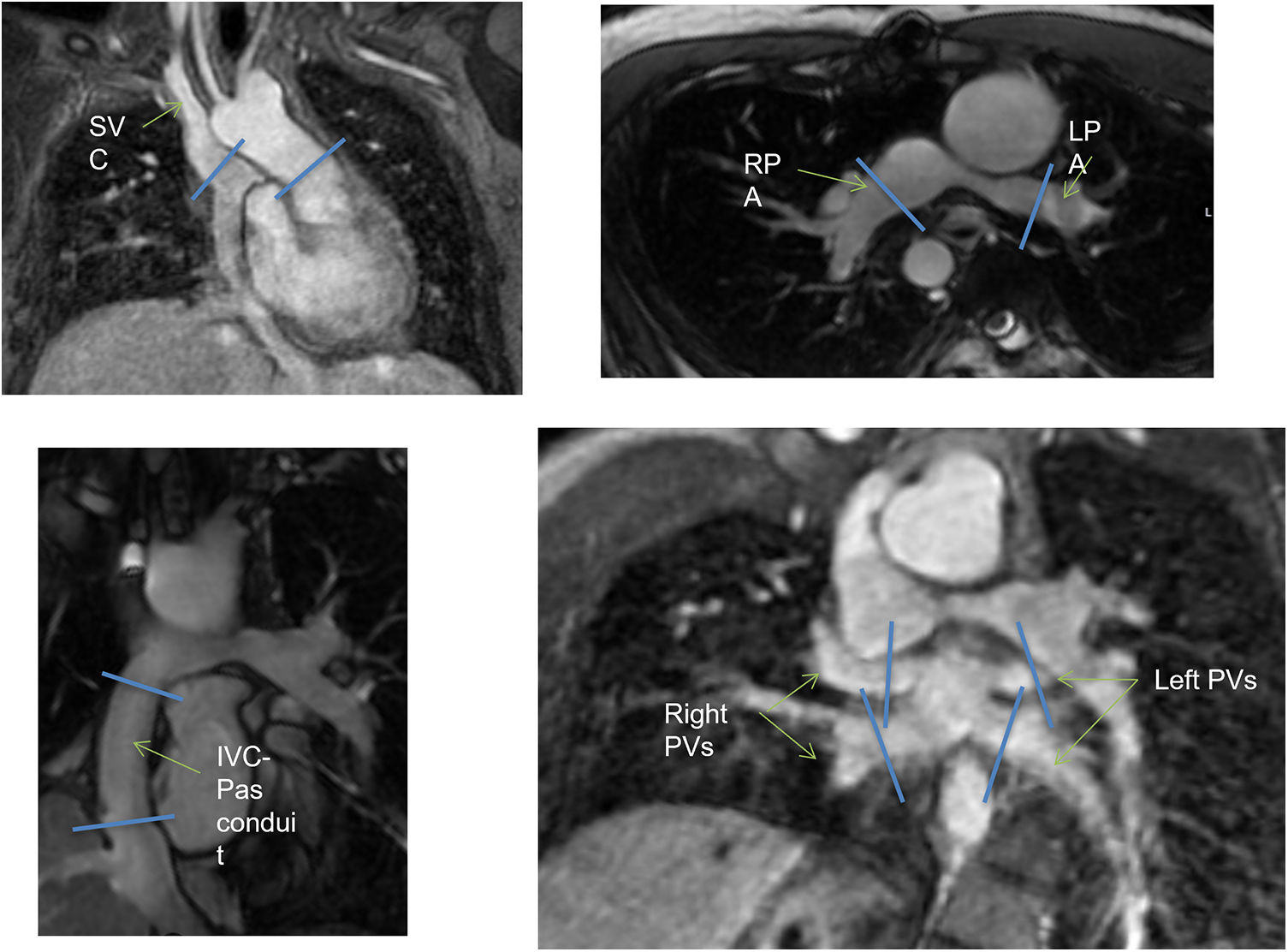 CHD | Free Full-Text | Comparison of 2D and 4D Flow MRI Measurements ...
