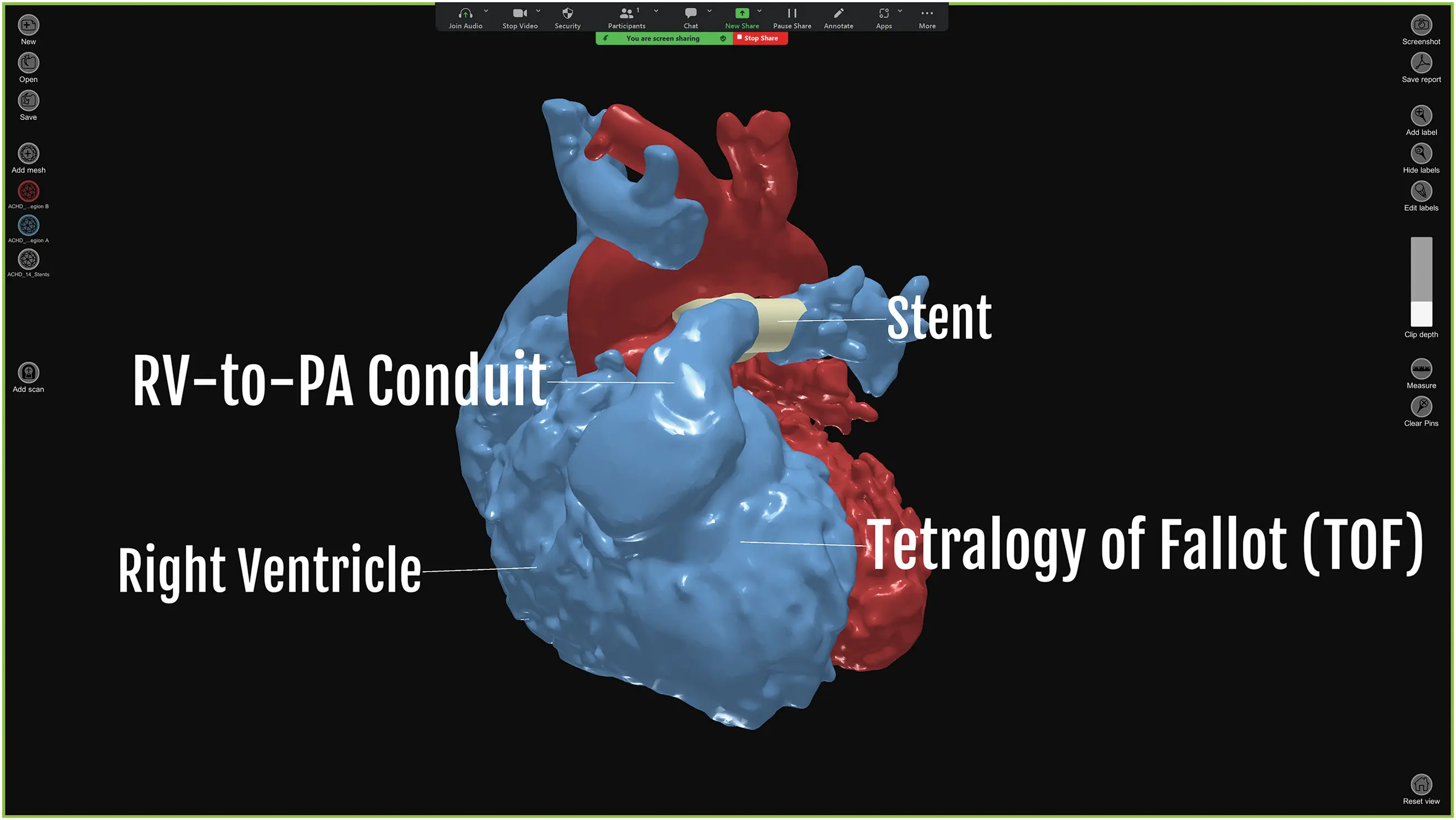 CHD | Free Full-Text | Use of Patient-Specific “4D” Tele-Education to ...