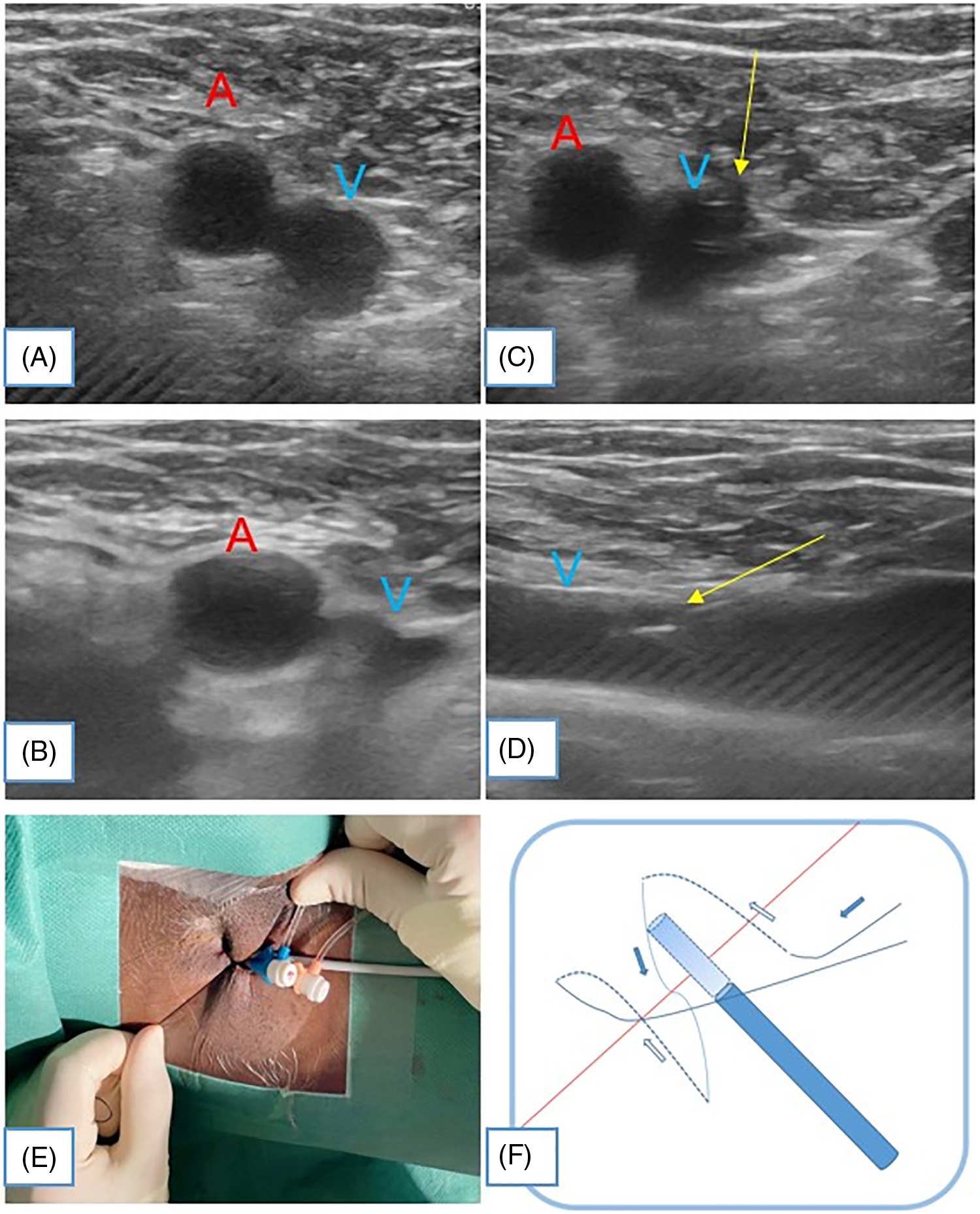 CHD | Free Full-Text | Femoral Access with Ultrasound-Guided Puncture ...