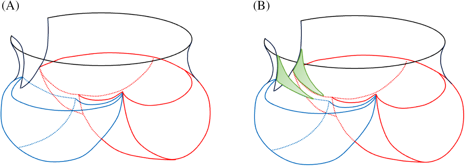 CHD | Free Full-Text | Bicuspidization Using the Open-Sleeve Technique ...