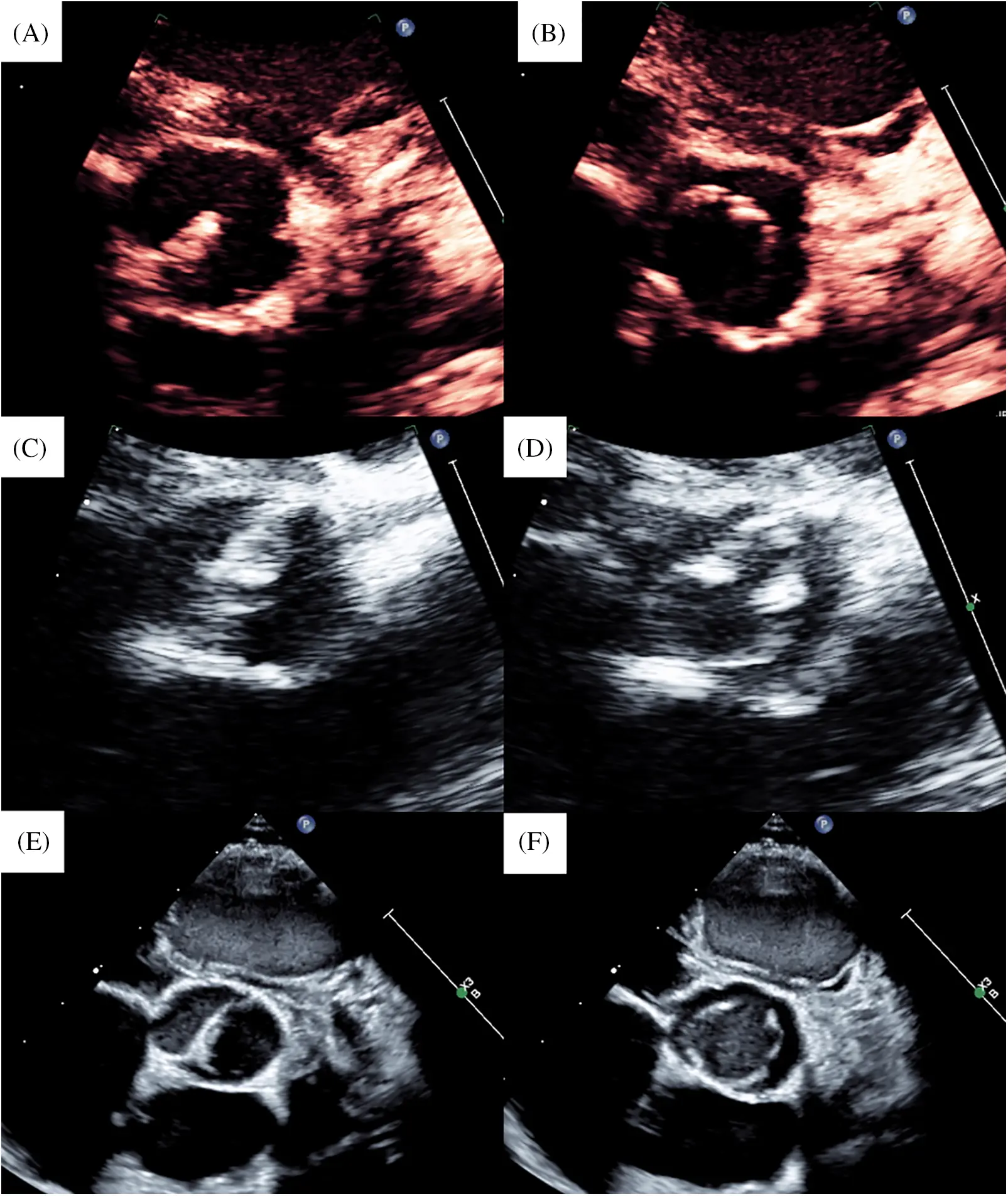 CHD | Free Full-Text | Bicuspidization Using the Open-Sleeve Technique ...
