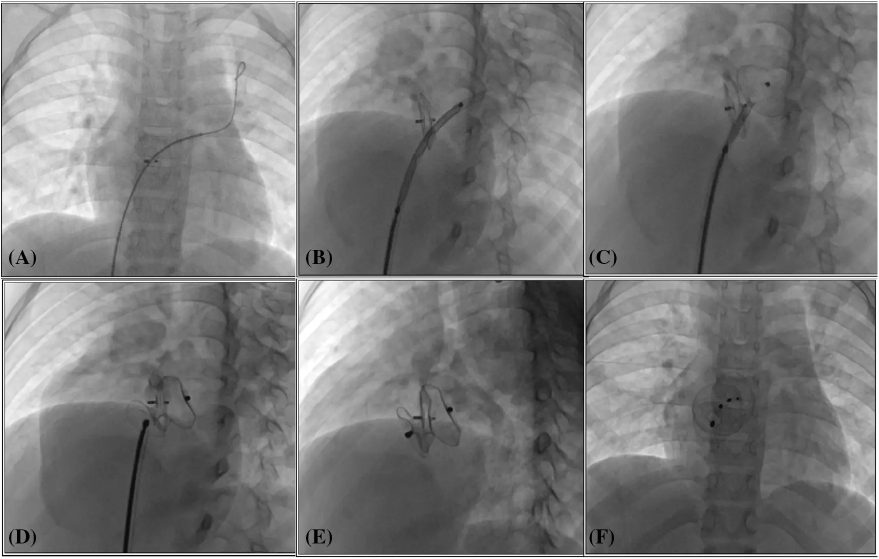 CHD | Free Full-Text | Transcatheter Closure of Postoperative Residual ...