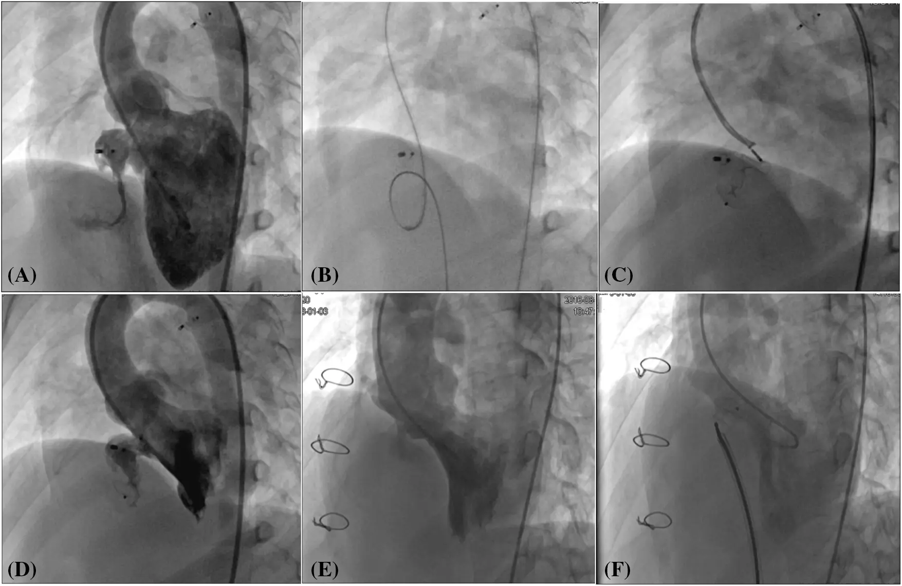 CHD | Free Full-Text | Transcatheter Closure of Postoperative Residual ...
