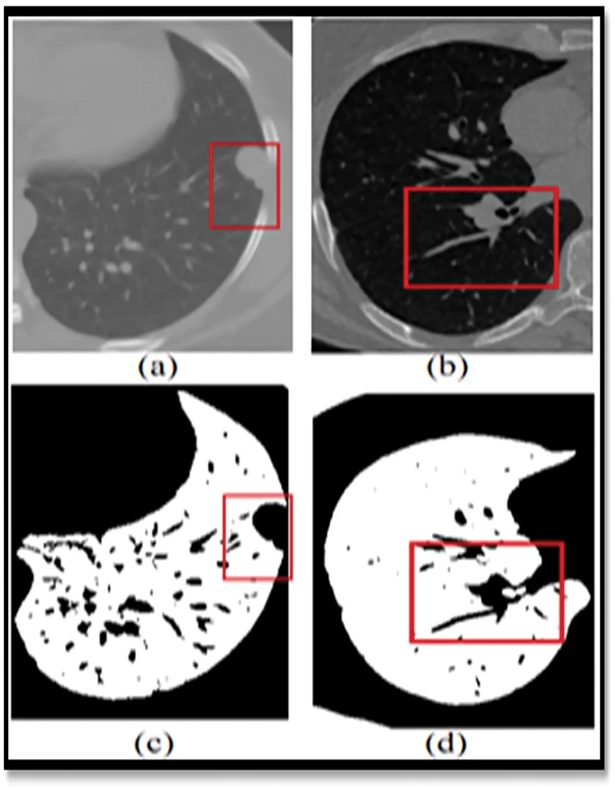 CMC | Free Full-Text | Lung Cancer Segmentation with Three-Parameter ...
