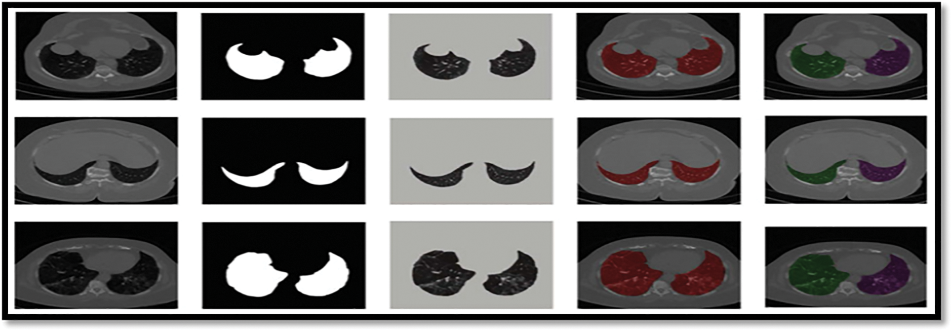 CMC | Free Full-Text | Lung Cancer Segmentation with Three-Parameter ...