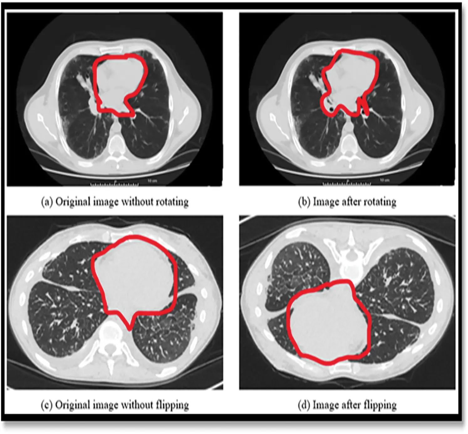 CMC | Free Full-Text | Lung Cancer Segmentation with Three-Parameter ...