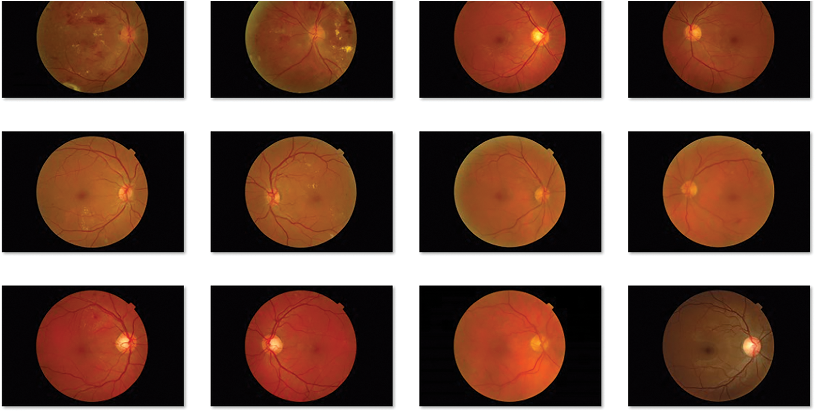 CMC | Free Full-Text | Blood Vessel Segmentation with Classification Model for Diabetic ...