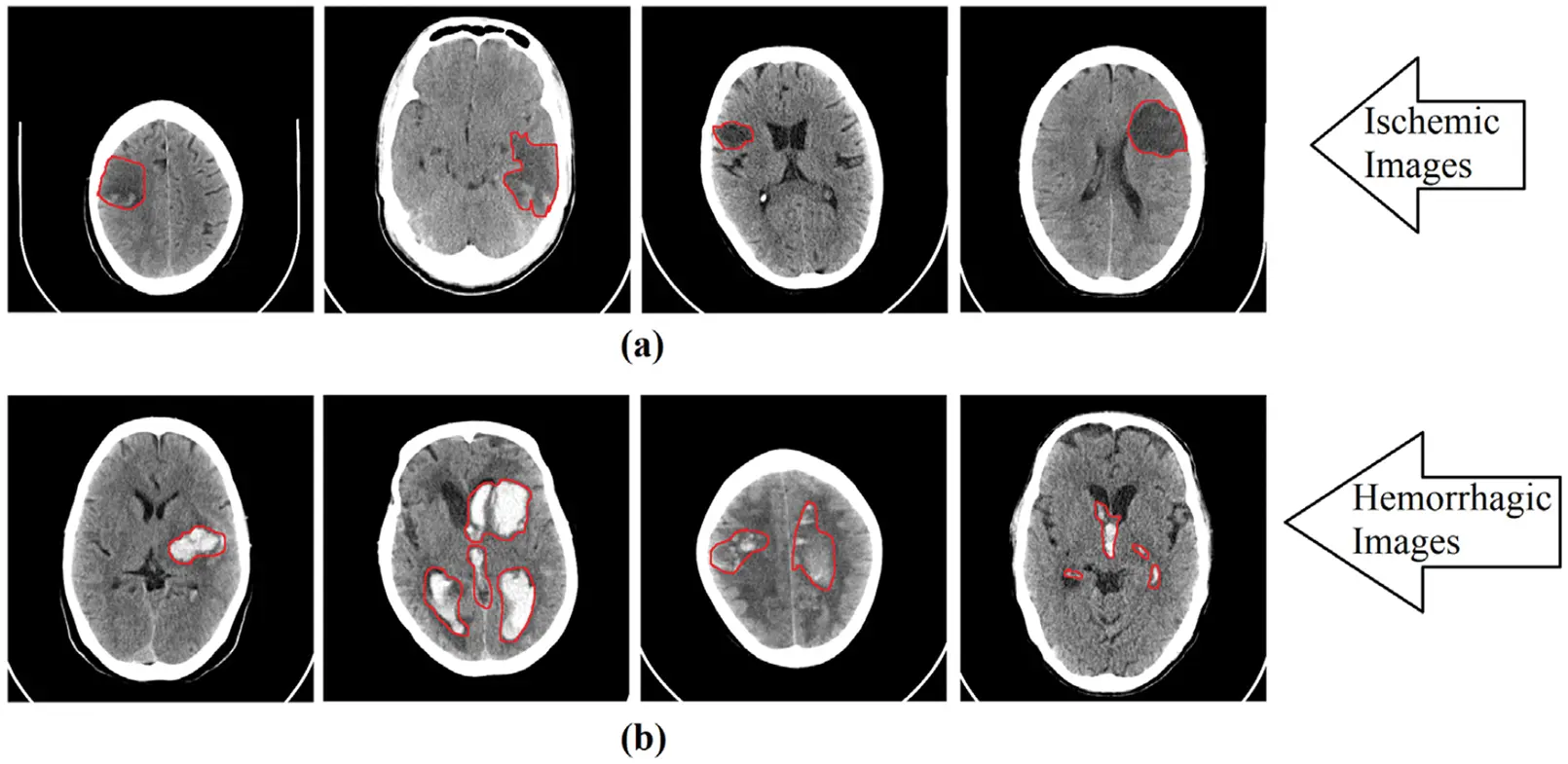 CMC | Free Full-Text | Deep Learning-Enabled Brain Stroke Classification on Computed Tomography ...
