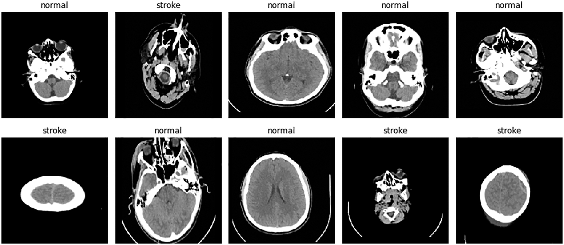 CMC | Free Full-Text | Deep Learning-Enabled Brain Stroke Classification on Computed Tomography ...