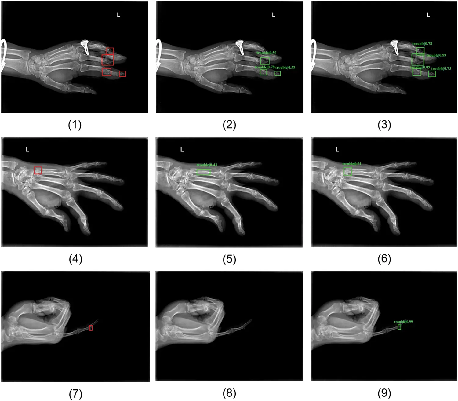 CMC | Free Full-Text | MPFracNet: A Deep Learning Algorithm for ...