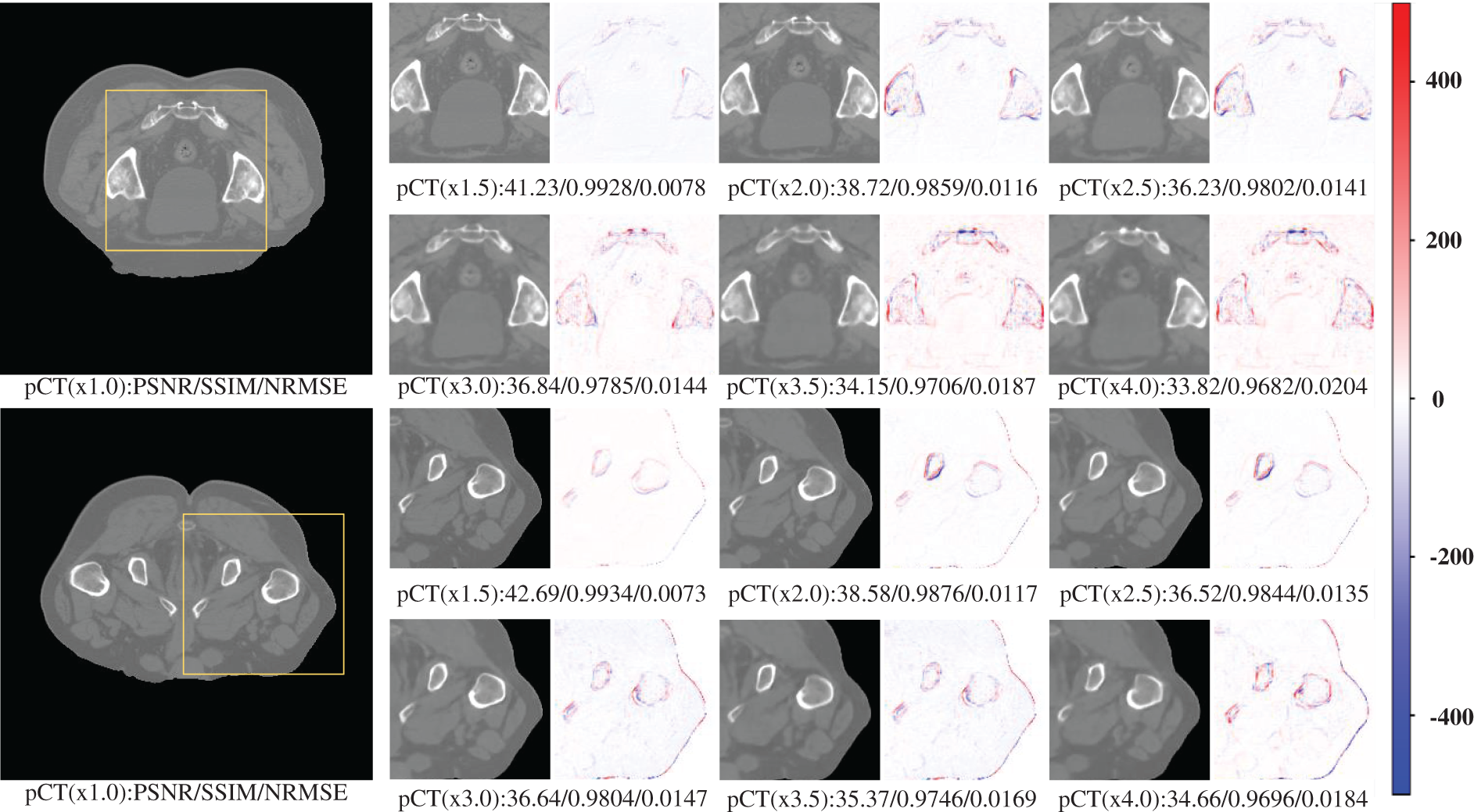CMC | Free Full-Text | Meta-Learning Multi-Scale Radiology Medical Image Super-Resolution