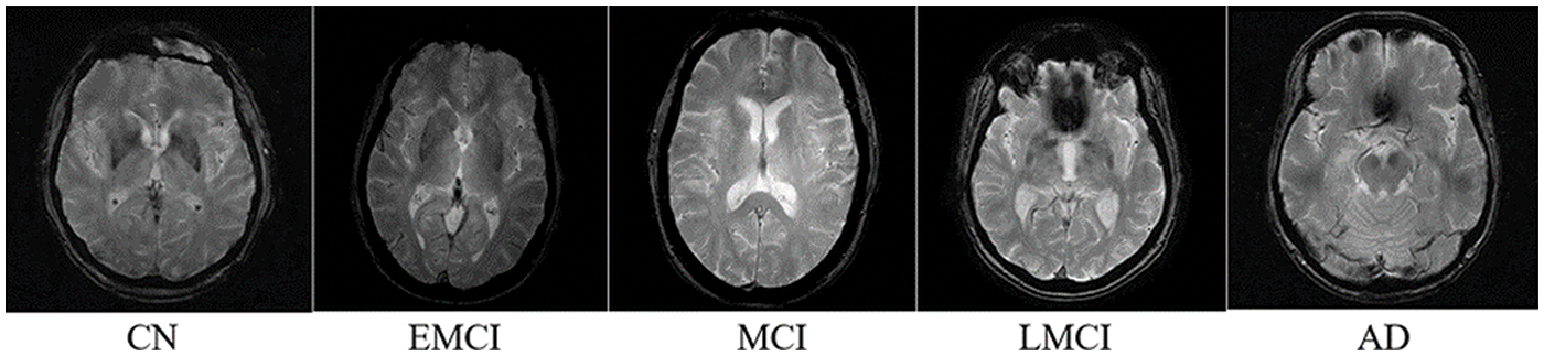 CMC | Free Full-Text | Detection of Different Stages of Alzheimer’s ...