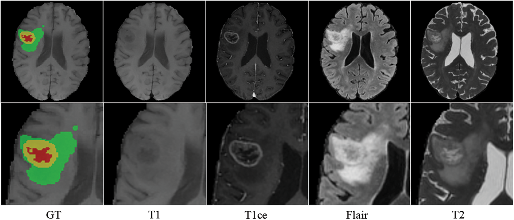 CMC | Free Full-Text | Clinical Knowledge-Based Hybrid Swin Transformer for Brain Tumor Segmentation