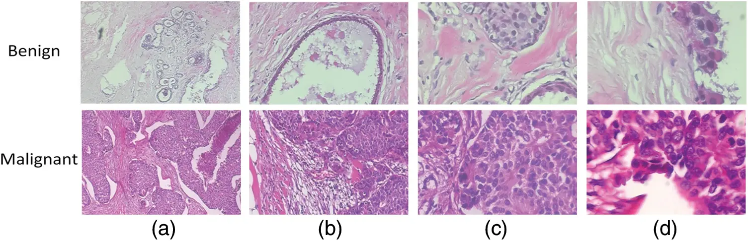 CMC | Free Full-Text | Recognizing Breast Cancer Using Edge-Weighted ...