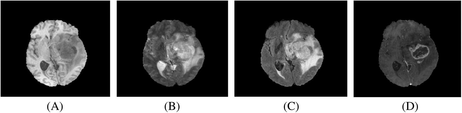 CMC | Free Full-Text | EMU-Net: Automatic Brain Tumor Segmentation and Classification Using ...