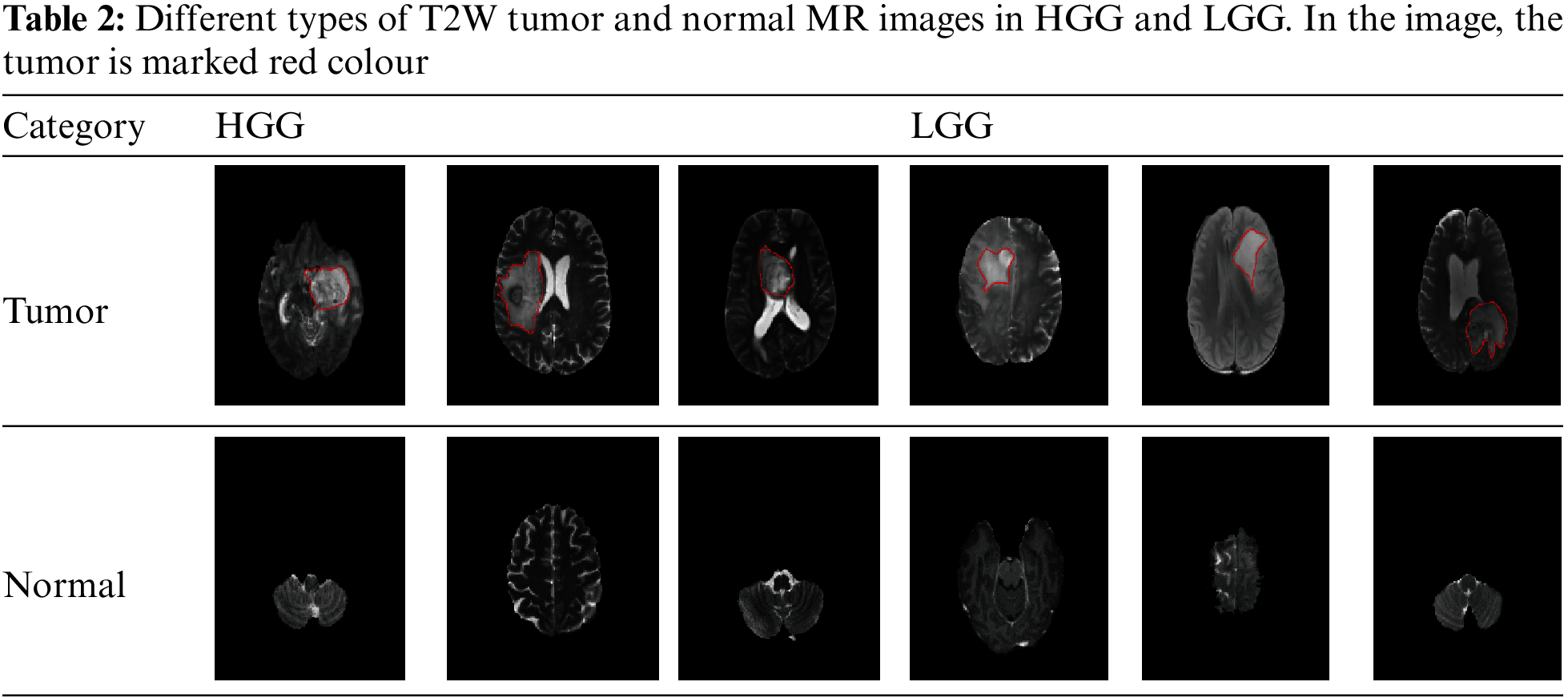 CMC | Free Full-Text | EMU-Net: Automatic Brain Tumor Segmentation and ...