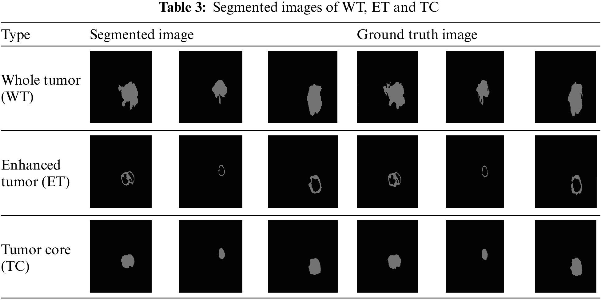 CMC | Free Full-Text | EMU-Net: Automatic Brain Tumor Segmentation and Classification Using ...