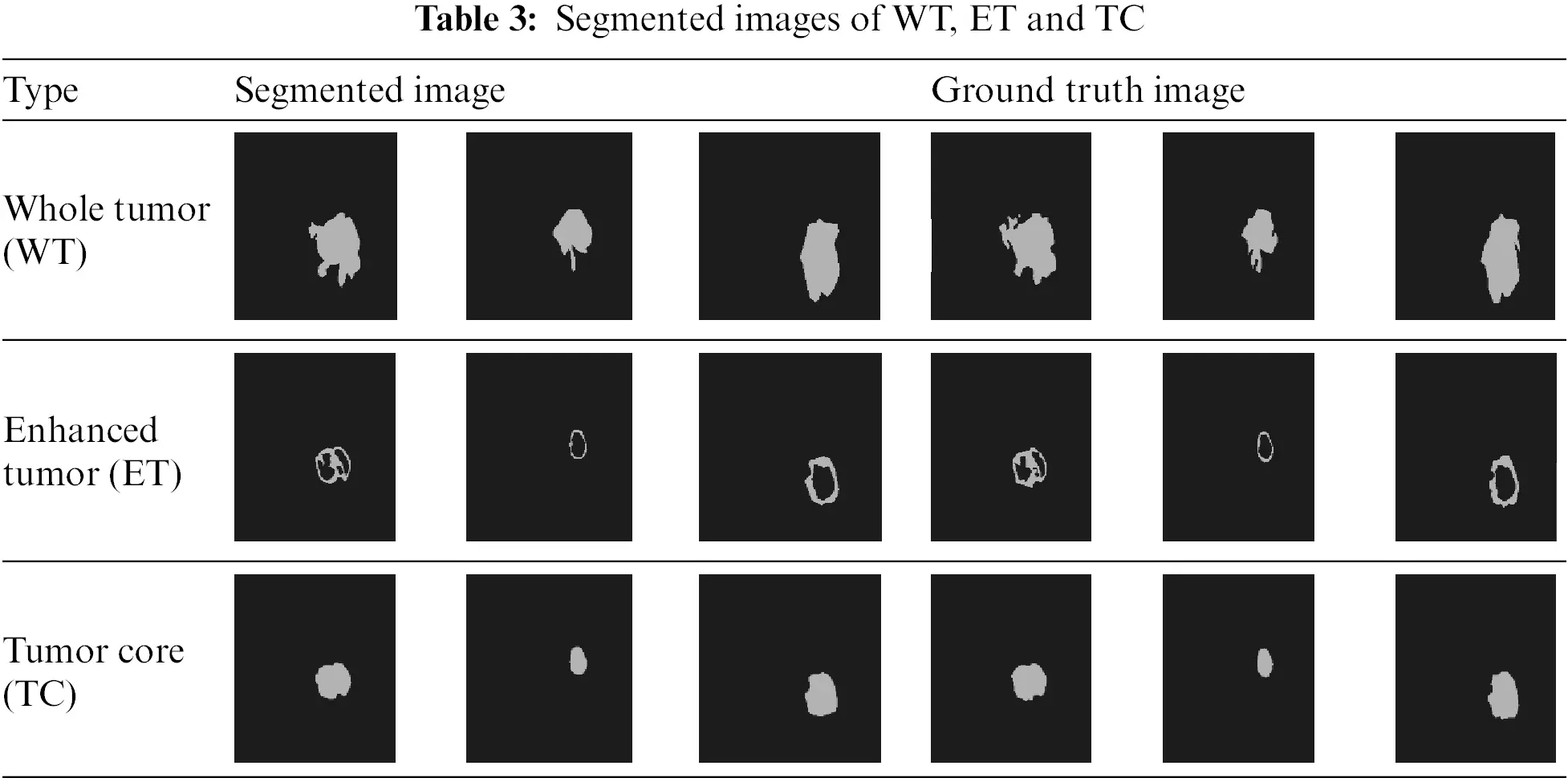 CMC | Free Full-Text | EMU-Net: Automatic Brain Tumor Segmentation and Classification Using ...