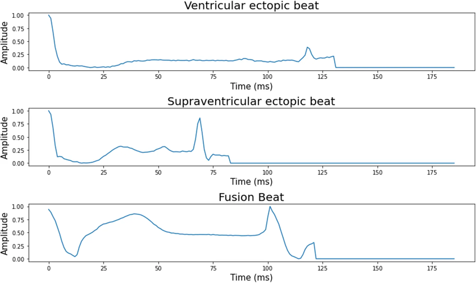 CMC | Free Full-Text | Classification of Electrocardiogram Signals for ...