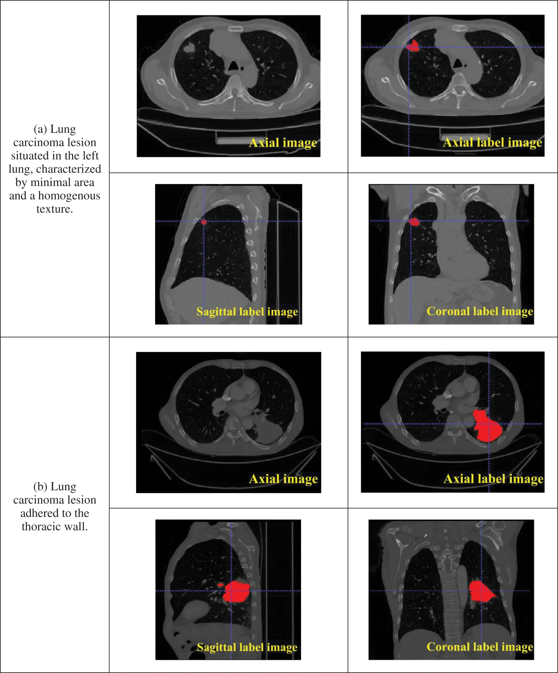 CMC | Free Full-Text | Multilevel Attention Unet Segmentation Algorithm for Lung Cancer Based on ...