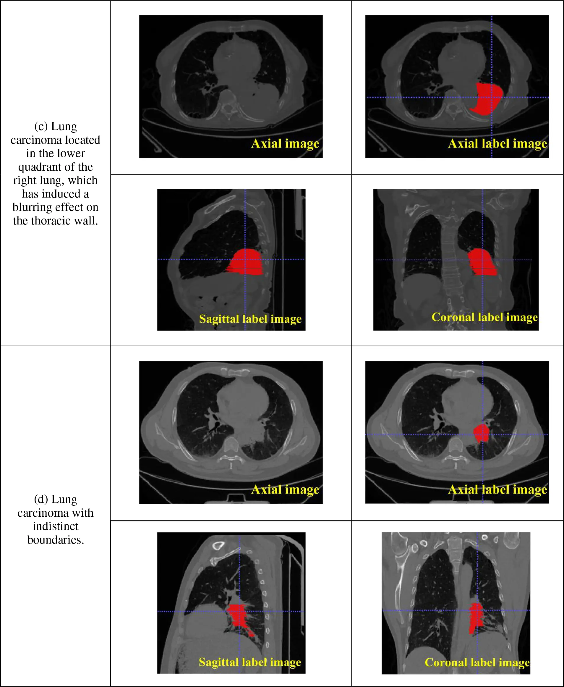 CMC | Free Full-Text | Multilevel Attention Unet Segmentation Algorithm for Lung Cancer Based on ...