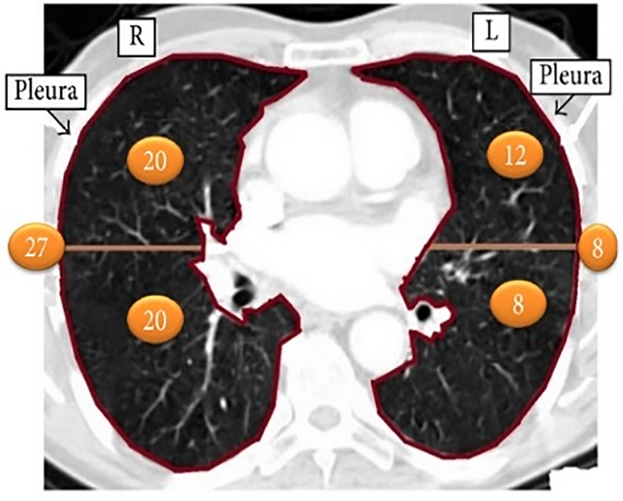 CMC | Free Full-Text | Nodule Detection Using Local Binary Pattern Features to Enhance ...