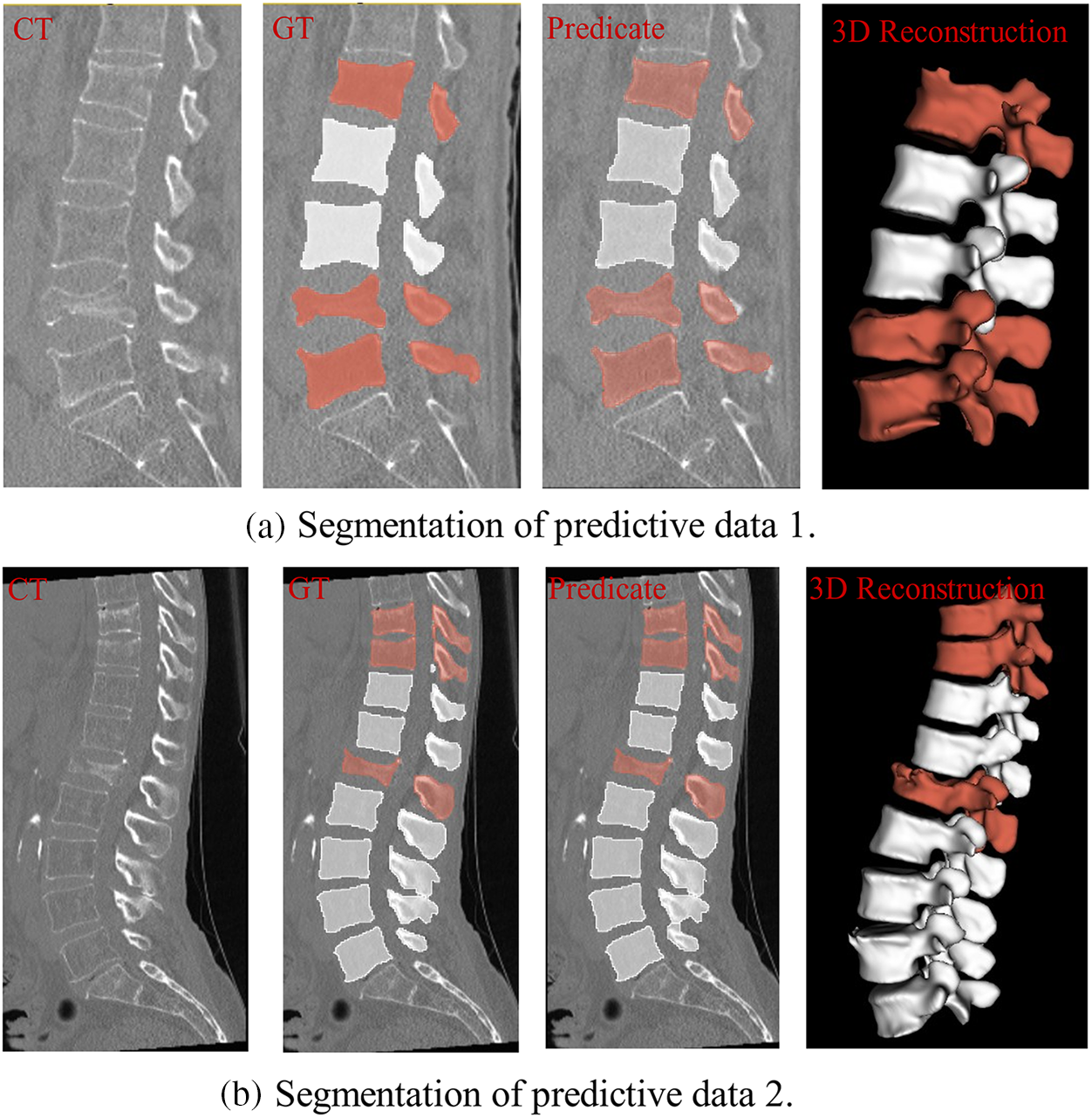 CMC | Free Full-Text | Spinal Vertebral Fracture Detection and Fracture ...