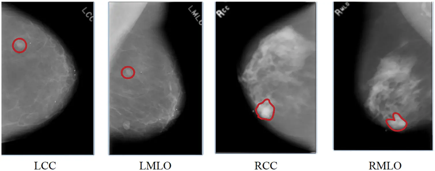 CSSE | Free Full-Text | Classification of Multi-view Digital Mammogram ...