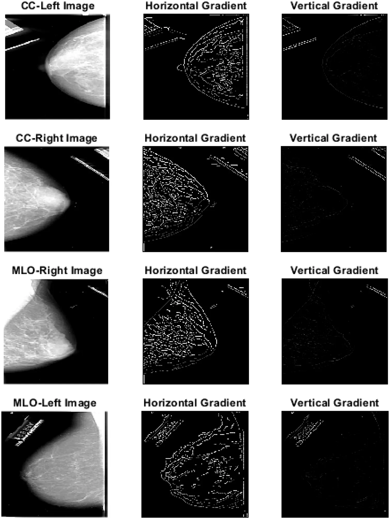 CSSE | Free Full-Text | Classification of Multi-view Digital Mammogram Images Using SMO-WkNN