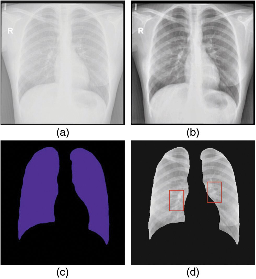 CSSE | Free Full-Text | Computer-Aided Diagnosis for Tuberculosis ...