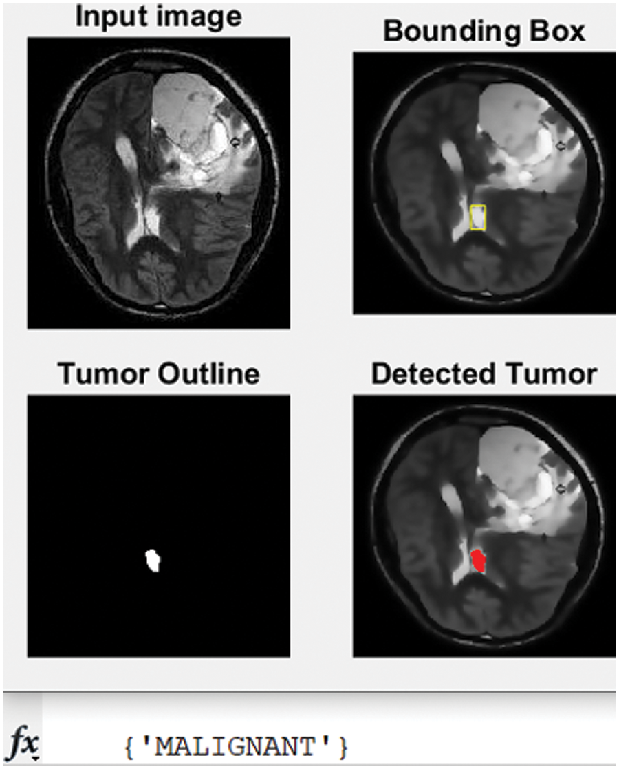 CSSE | Free Full-Text | An Effective Diagnosis System for Brain Tumor Detection and Classification