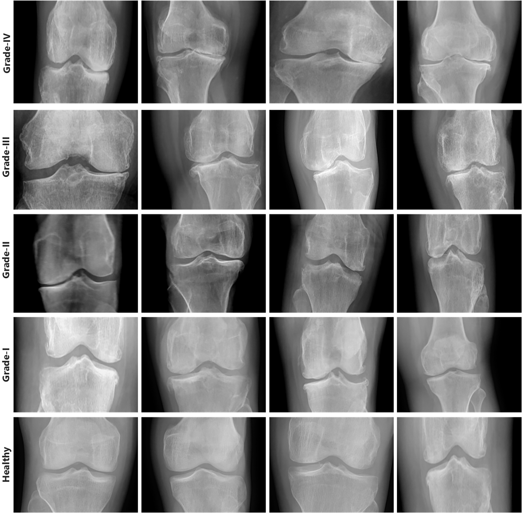 CSSE | Free Full-Text | A Robust Approach for Detection and Classification of KOA Based on ...