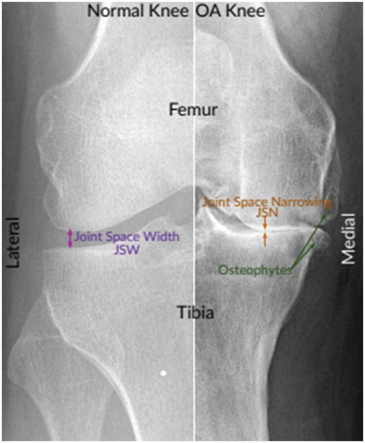 CSSE | Free Full-Text | Knee Osteoarthritis Classification Using X-Ray ...