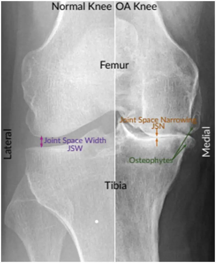 CSSE | Free Full-Text | Knee Osteoarthritis Classification Using X-Ray ...